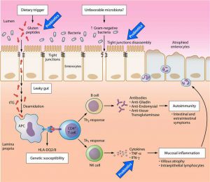 Gut Microbe and Celiac Disease – Live Biotherapeutics Blog
